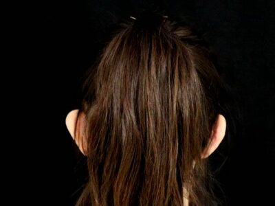 Otoplasty Correction Of Prominent Ears (Bat Ears) By Mark Sheldon Lloyd