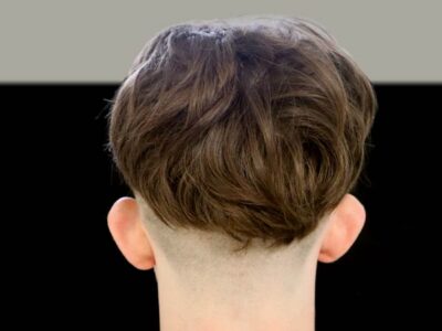 Otoplasty Correction Of Prominent Ears (Bat Ears) By Mark Sheldon Lloyd